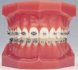 Maxilo blog: Las Seis llaves de la Oclusión Normal