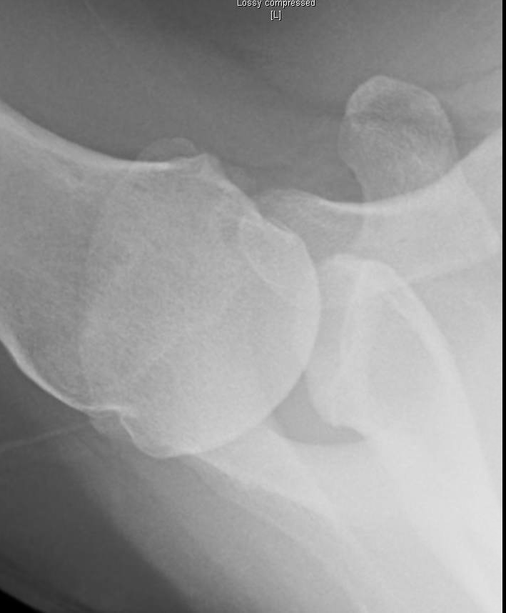 UW Shoulder and Elbow Academy: Glenoid dysplasia