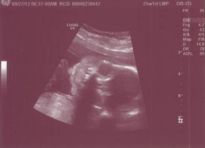Luke: Lighting Up Our Lives: Level II Ultrasound at 25 Weeks
