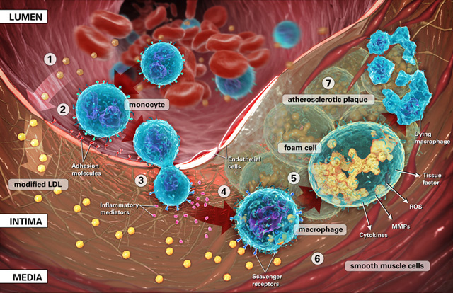 Arteriosclerose: Aterosclerose