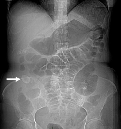 Revision Casos De Cirugia General: ILEO BILIAR
