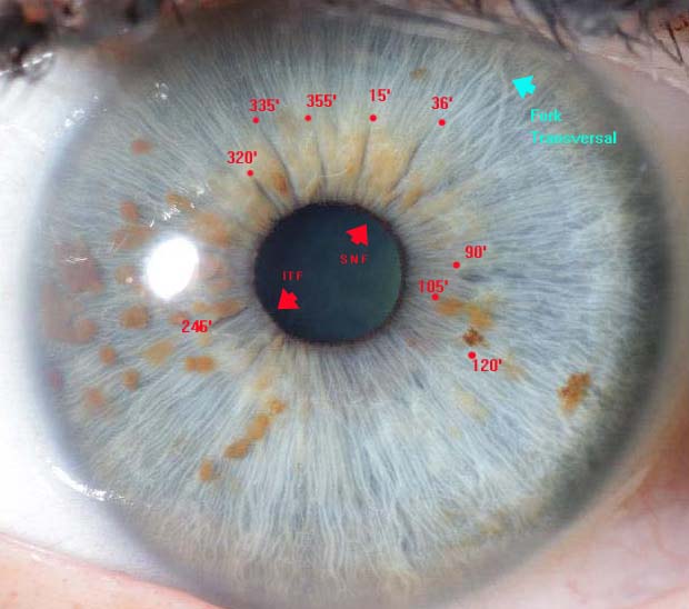 Modern & Multidimensional Iridology: Neurogenic, Psoric Type, Dyscratic ...
