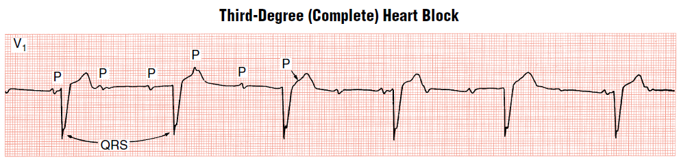 NOTA KEDOKTERAN: Interpretation of ECG (Introduction, Chambers ...