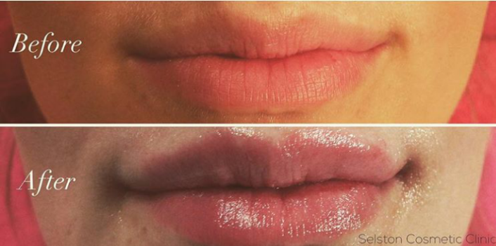Selston Cosmetic Clinic: Dermal Fillers To Create Natural Looking Lips ...