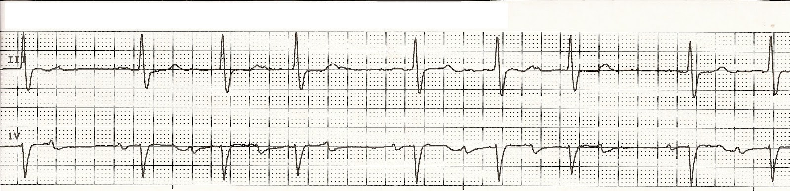 ACLS Rhythms: Heart blocks