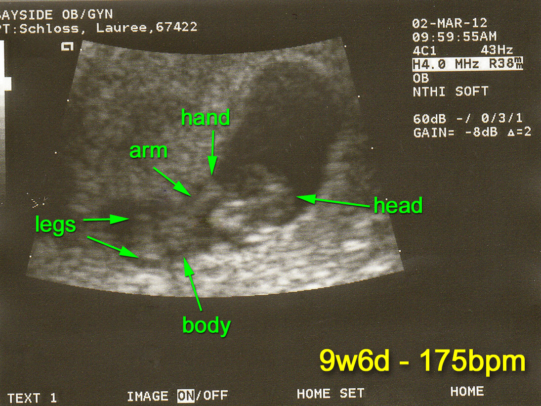 Just Relax and It Will Happen: 9w6d - God is GOOD - ultrasound