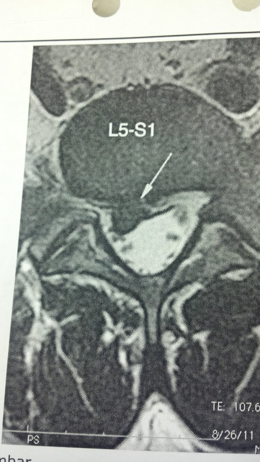 42 yo man w severe right leg pain w sciatica and large L5S1 disc ...