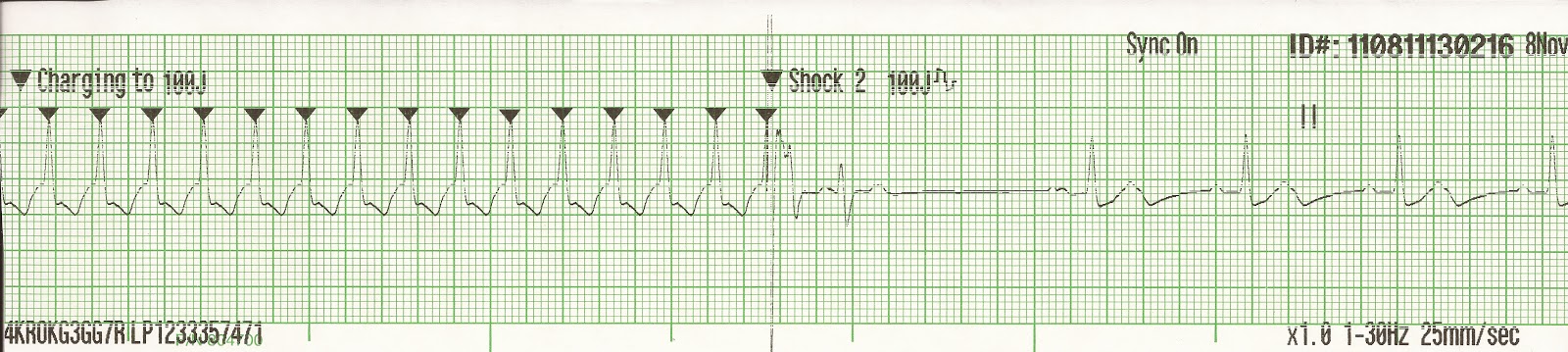 ECG Rhythm Strip Quiz 85: Electrical interventions
