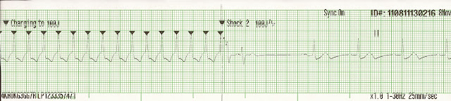 ECG Rhythm Strip Quiz 85: Electrical interventions