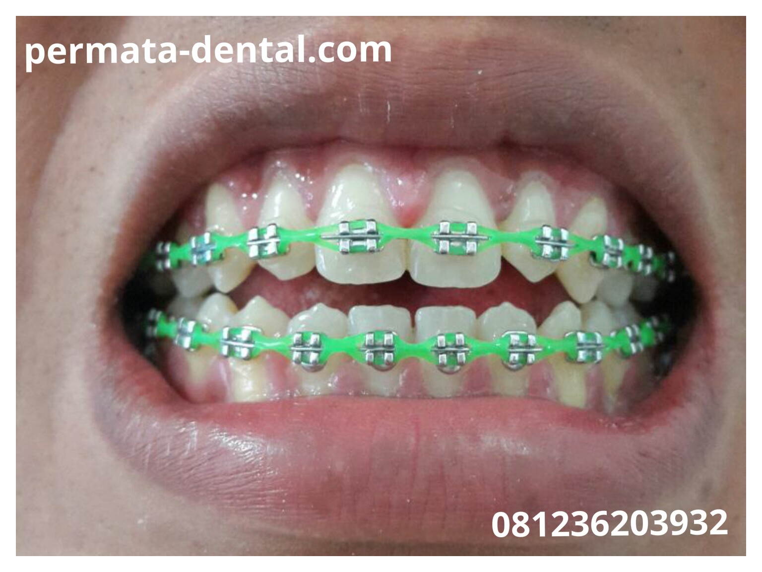 Klinik Gigi Jember Permata Dental : Pengen Punya Gigi Rapi Dan Terlihat ...
