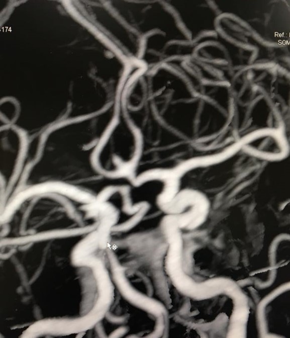 SAH with IVH, coiling and EVD done in same sitting in DSA | Science of ...