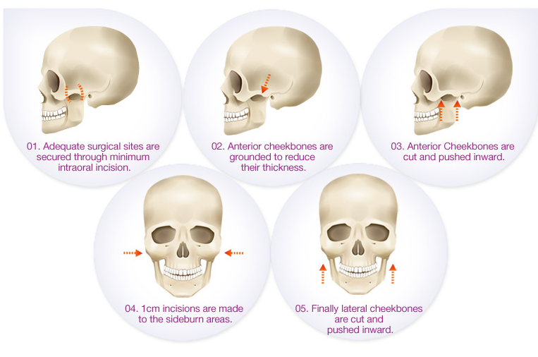 BK Plastic Surgery: [BK Plastic Surgery] 3D Cheekbone Reduction