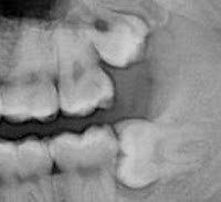 Wisdom Teeth