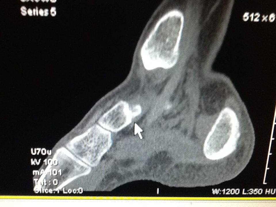 Foot and Ankle Problems By Dr. Richard Blake: Images for Os Navicularis ...