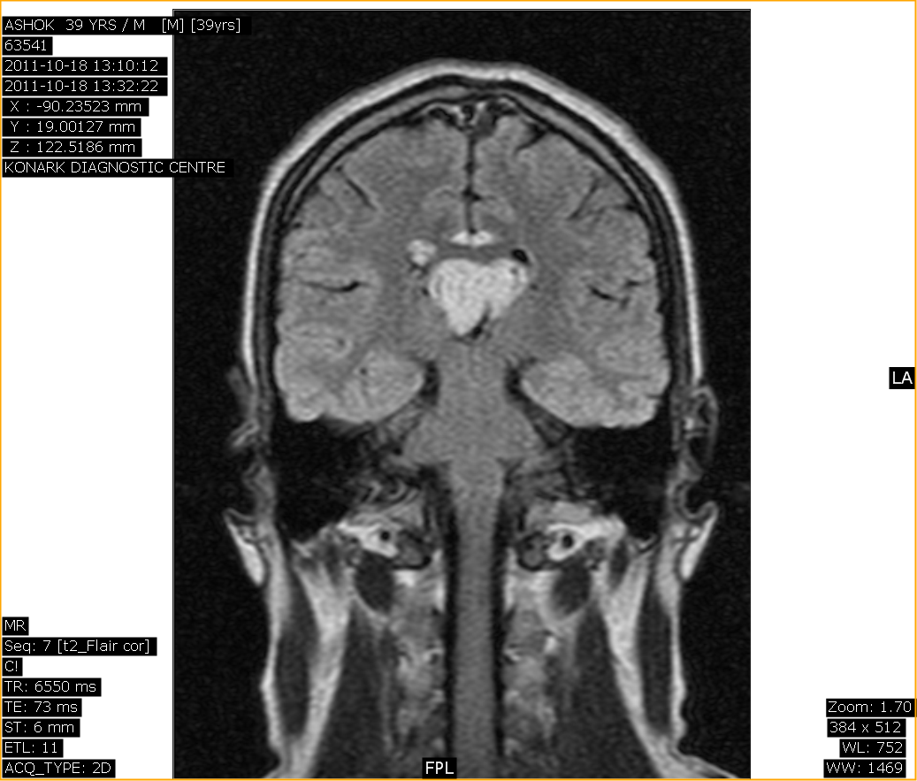 drvcsradiodiagnosis: corpus callosal lipoma- case report