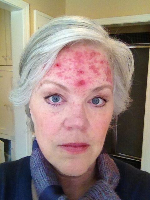 Boomer Girl Diary: Efudex Day 20: Better than it looks