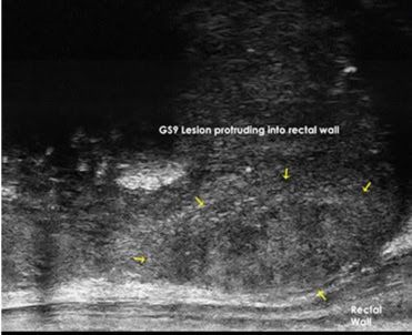 Dr. Fernando Gómez Sancha - English: ExactVu system, micro-ultrasound ...