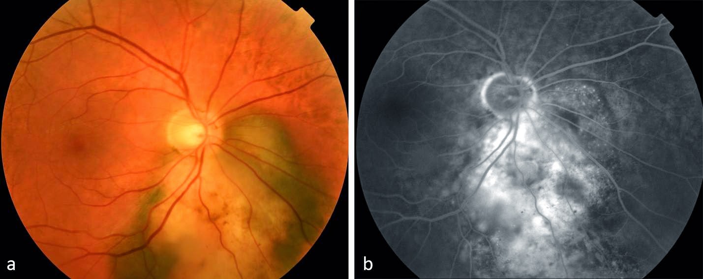 What's the Risk of Melanoma with a Choroidal Nevus? - Eyedolatry