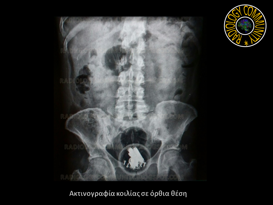 Radiology Community: Ανάδειξη ξένου σώματος σε Ακτινογραφία Κοιλίας