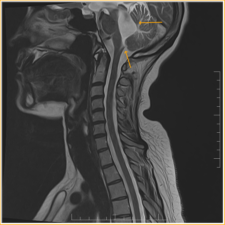 Obstruction of Magendie's Foramen :MRI - Sumer's Radiology Blog