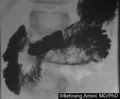 Roentgen Ray Reader: Duodenum Inversum