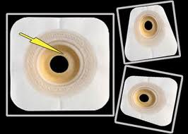 Colostomy Friends of the Philippines: Convex Wafers