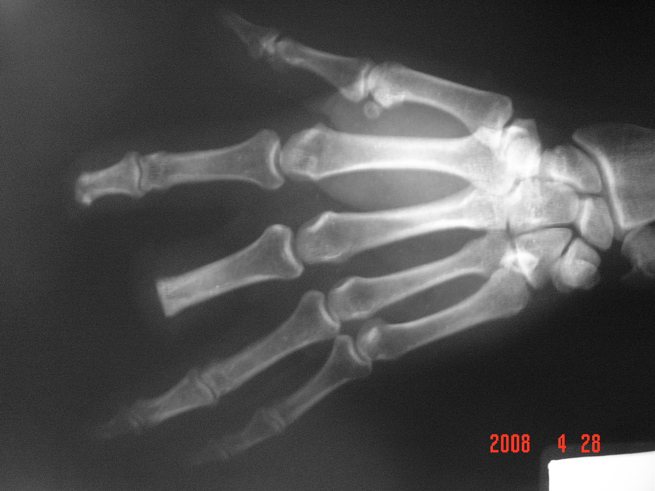 OSSA CARPALIA ©: AMPUTACIÓN TRAUMÁTICA DIGITAL