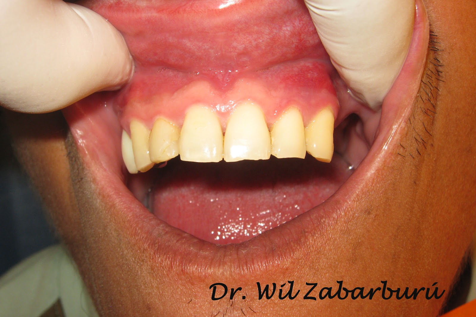 CLINICA DENTAL ASISTENCIAL: NEVUS FLAMMEUS