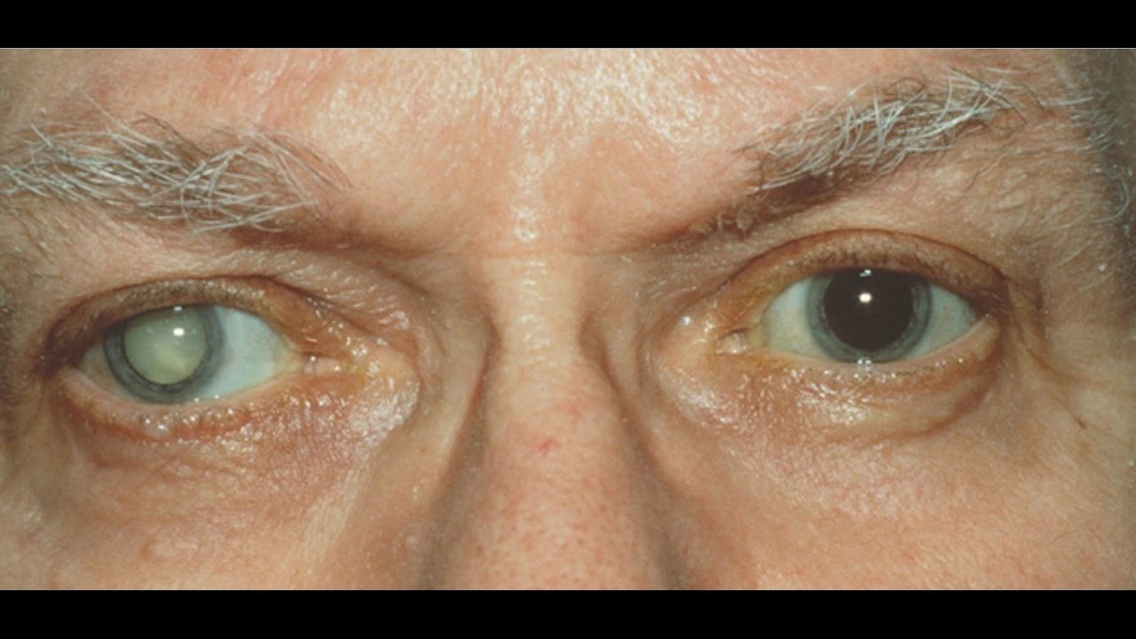 #HEALTH Clearing Cataracts, Dry Eye and Floaters - Health and Wellness