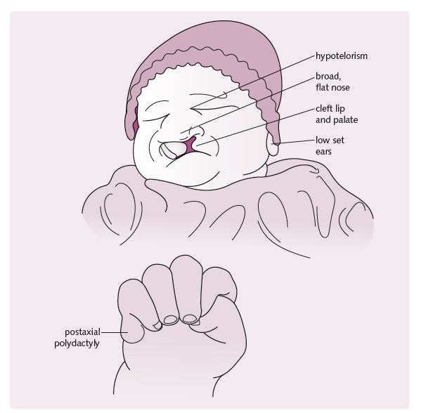 NurseTecmilenio: Genetic Mutations: Patau syndrome