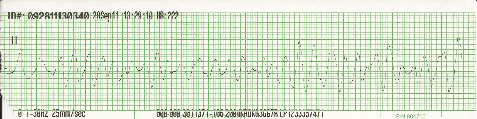 ACLS Rhythms: Ventricular rhythms