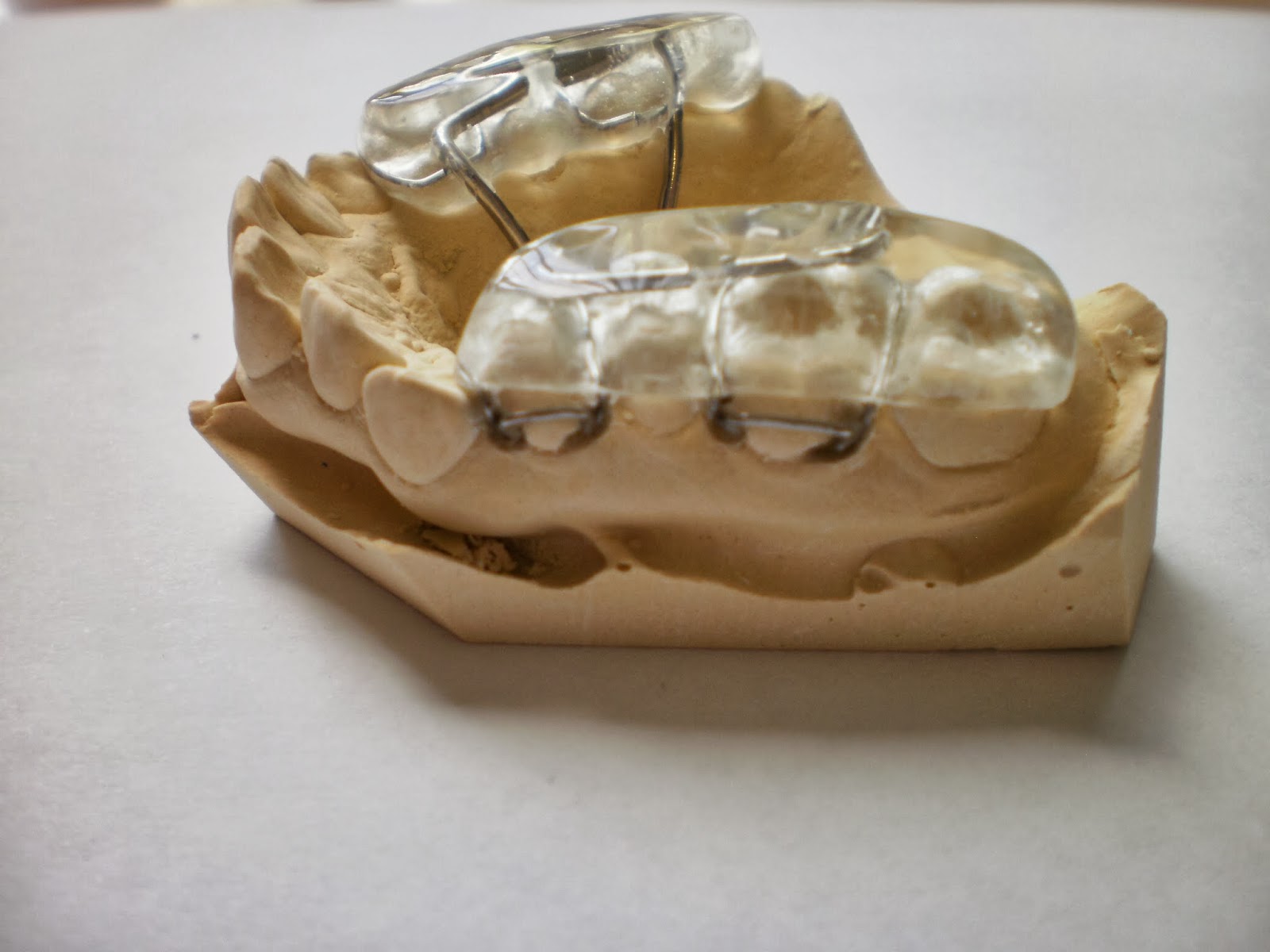 Straight teeth, Straight Talk: The Removable Bonded RPE