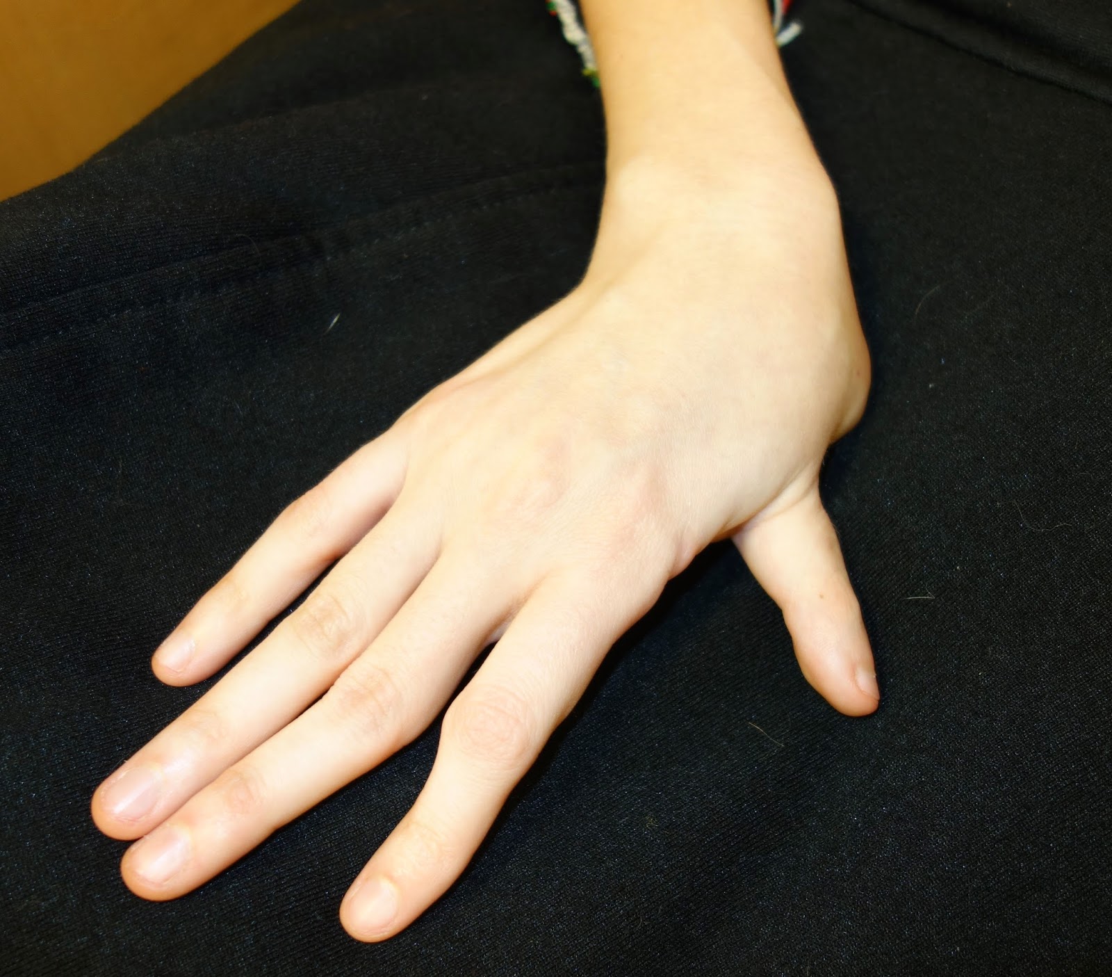 Thumb Deformity in Untreated Thumb Hypoplasia | Congenital Hand and Arm ...
