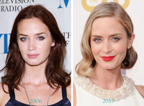 Emily Blunt Plastic Surgery Before and After Chin Implants, Cheek and ...