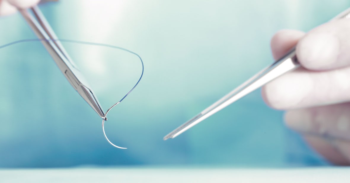 Ob/Gyn Updated : Sutures are better than staples in third or high-order ...