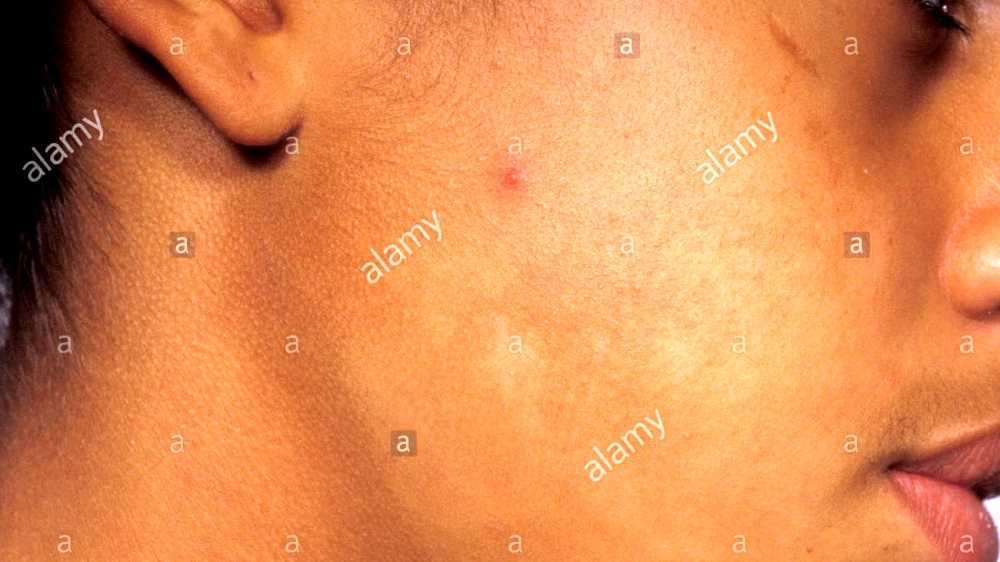Pityriasis alba