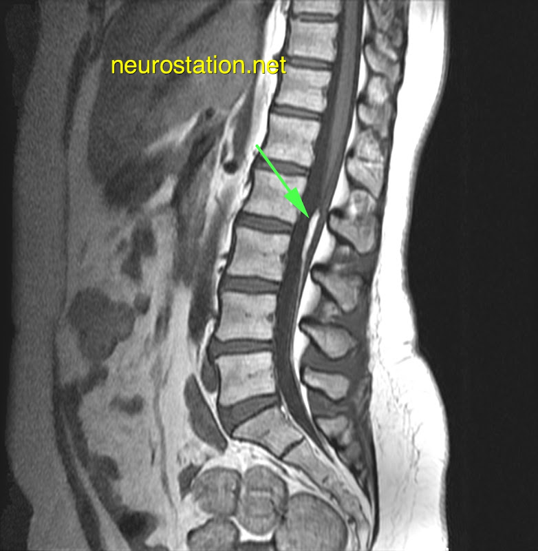 Incidental Finding on Lumbar Spine MRI | Neurostation