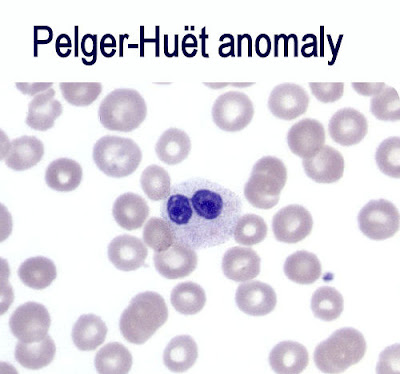 Medical Laboratory and Biomedical Science: Benign Pelger-Huët anomaly