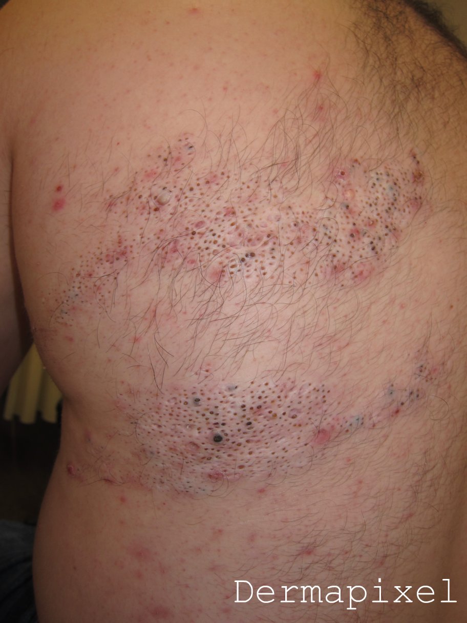 Dermapixel: Un acné muy raro