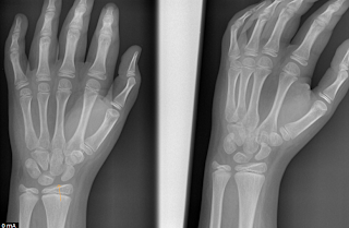 Terry Thomas Sign-Plain Film - Sumer's Radiology Blog