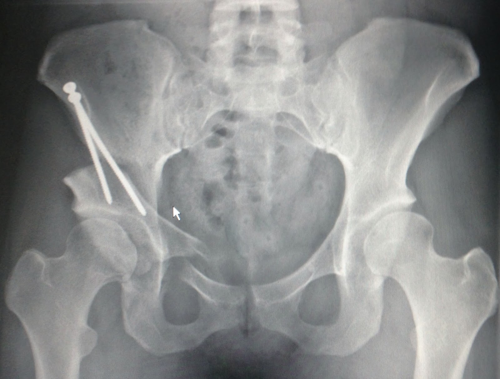 Hip xray normal vs bad hip joints - randomkery