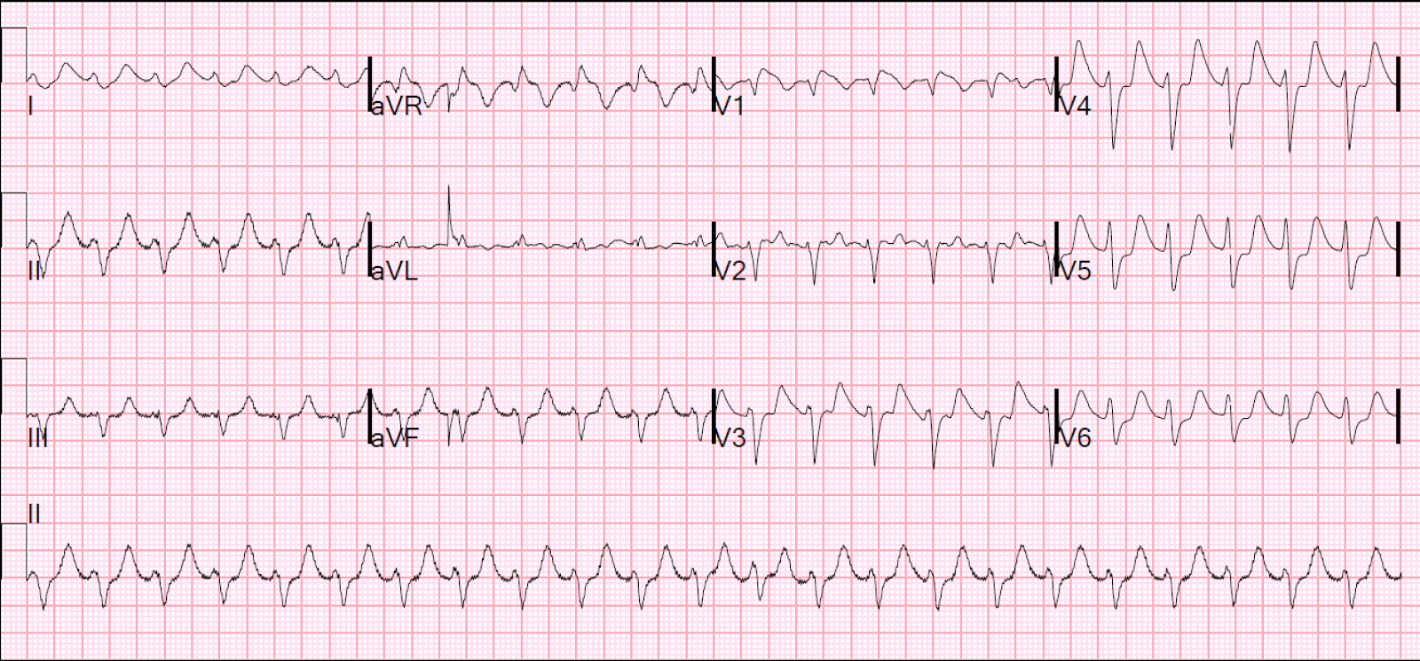 Dr. Smith's ECG Blog: The Effect of Calcium on Severe Hyperkalemia