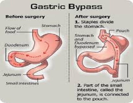 gastric bypass complications
