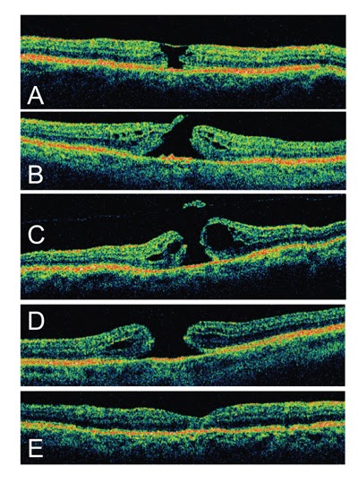 OCT Scans are Used to More Accurately Diagnose & Treat Many Eye Diseases