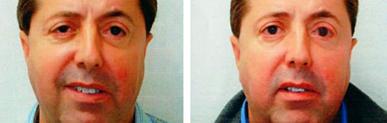 Boston Face Asymmetry correction without surgery, with Botox and ...