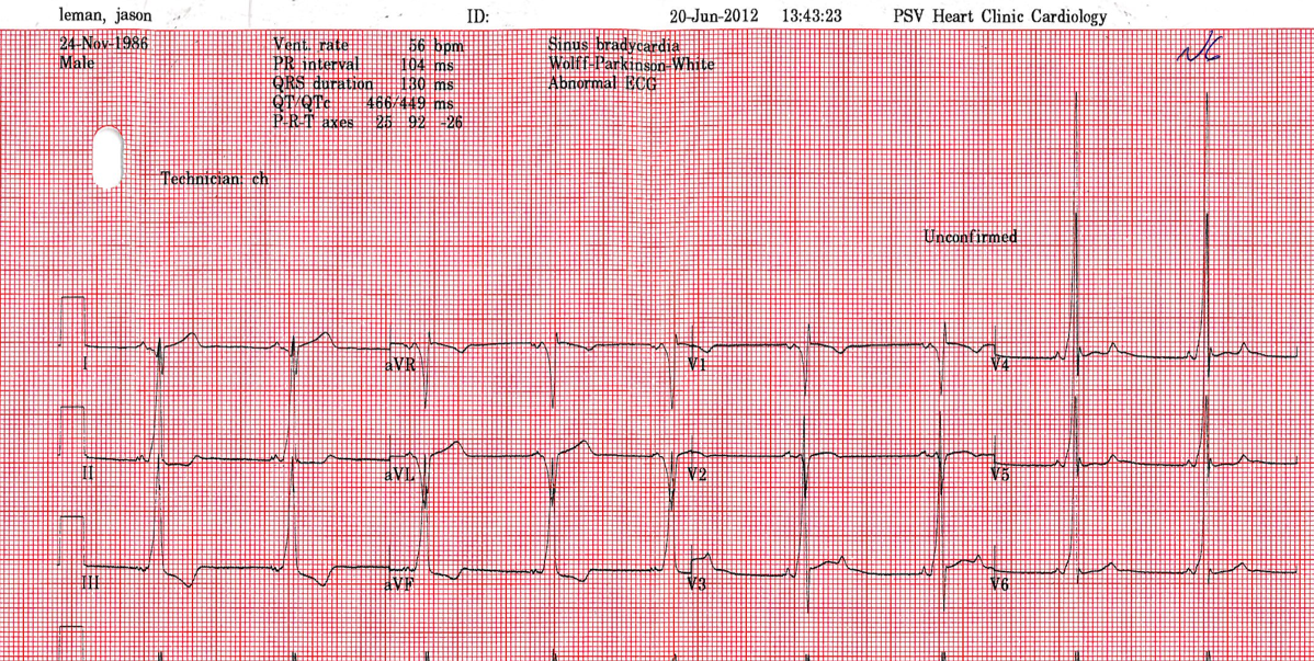 Forever Pace: My Rapid Heartbeat = Wolff-Parkinson-White syndrome
