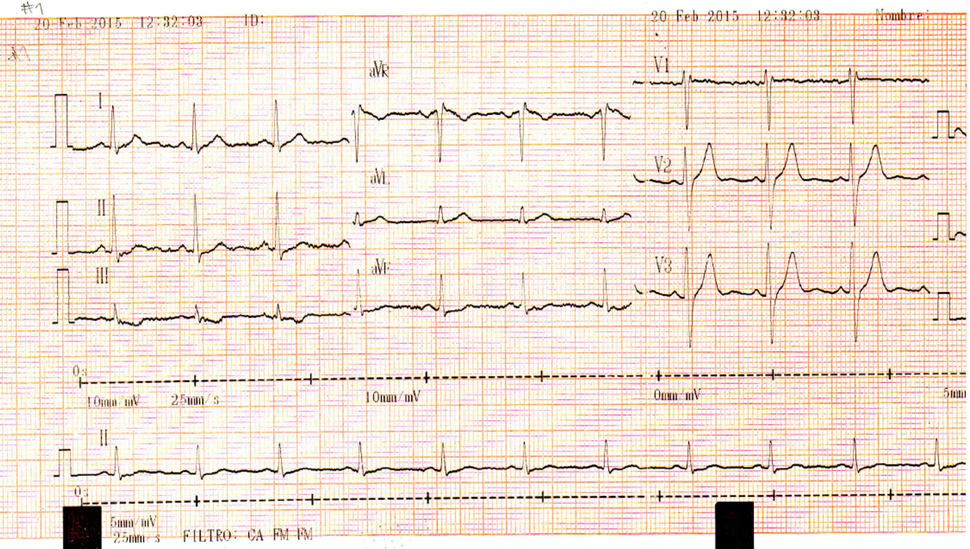 Fisiología Médica: Corazón: Electrocardiograma (ECG)