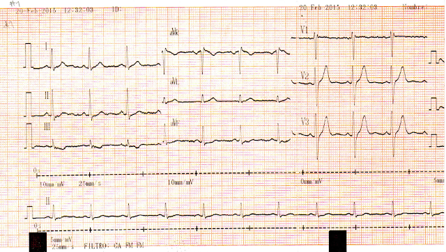 Fisiología Médica: Corazón: Electrocardiograma (ECG)
