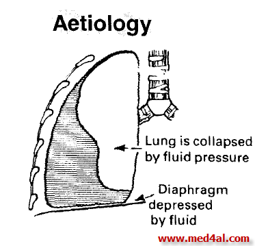 Pleural effusion def., causes, symptoms, signs and treatment