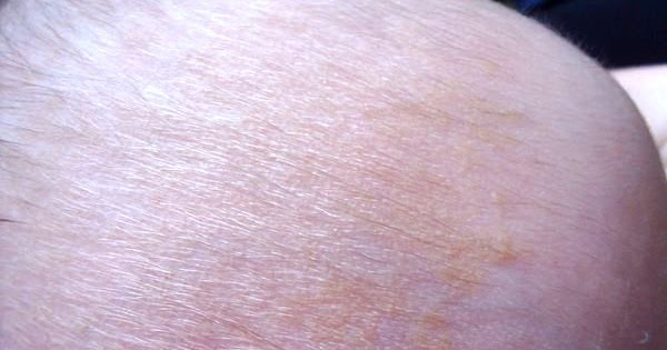 Ciemieniucha jak się szybko jej pozbyć?